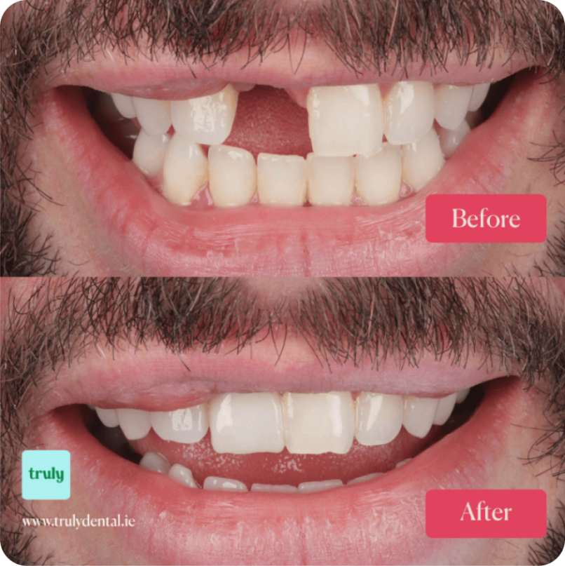 Full Mouth Implants - TruSmile - Truly Dental