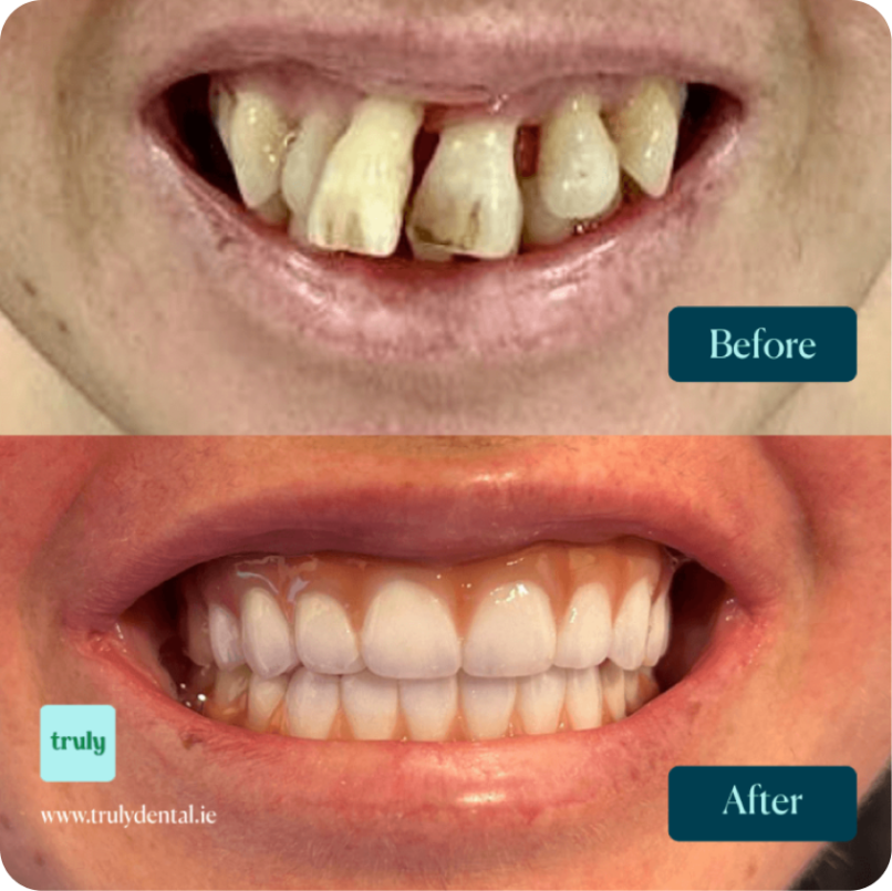 Full Mouth Implants - TruSmile - Truly Dental