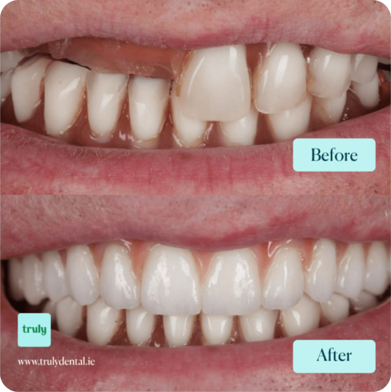Full Mouth Implants - TruSmile - Truly Dental