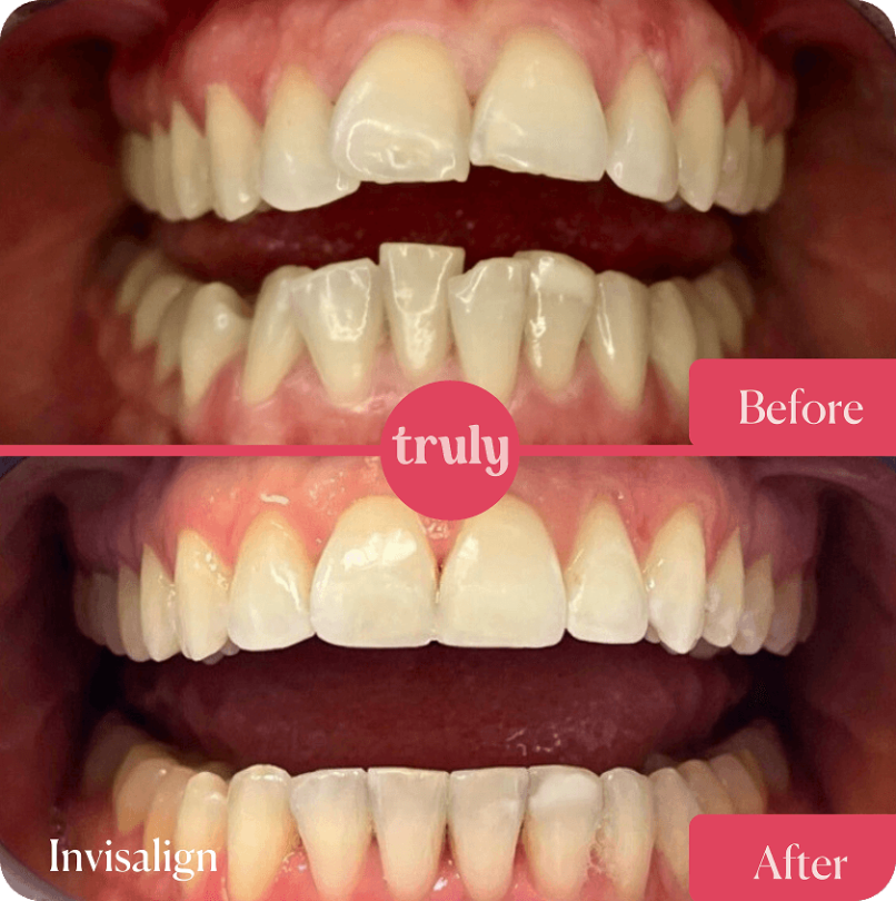 Invisalign - Truly Dental