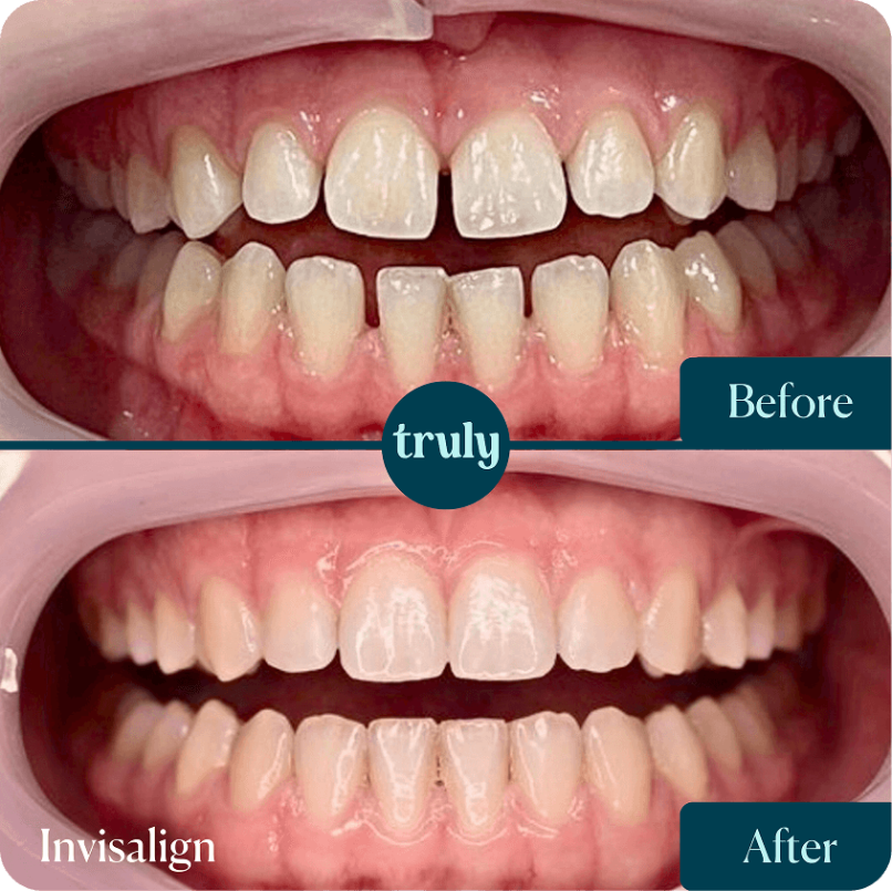 Invisalign - Truly Dental