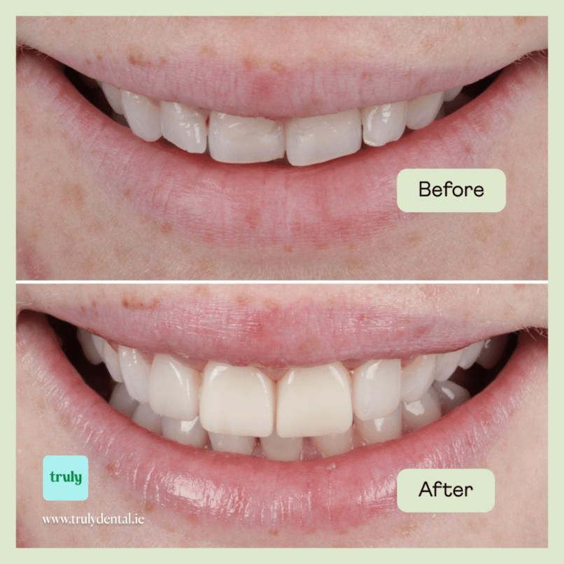 Composite Bonding - Truly Dental